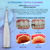 Ultrasonic Tooth Cleaner - Dental Hygiene Tool for Plaque Removal ...